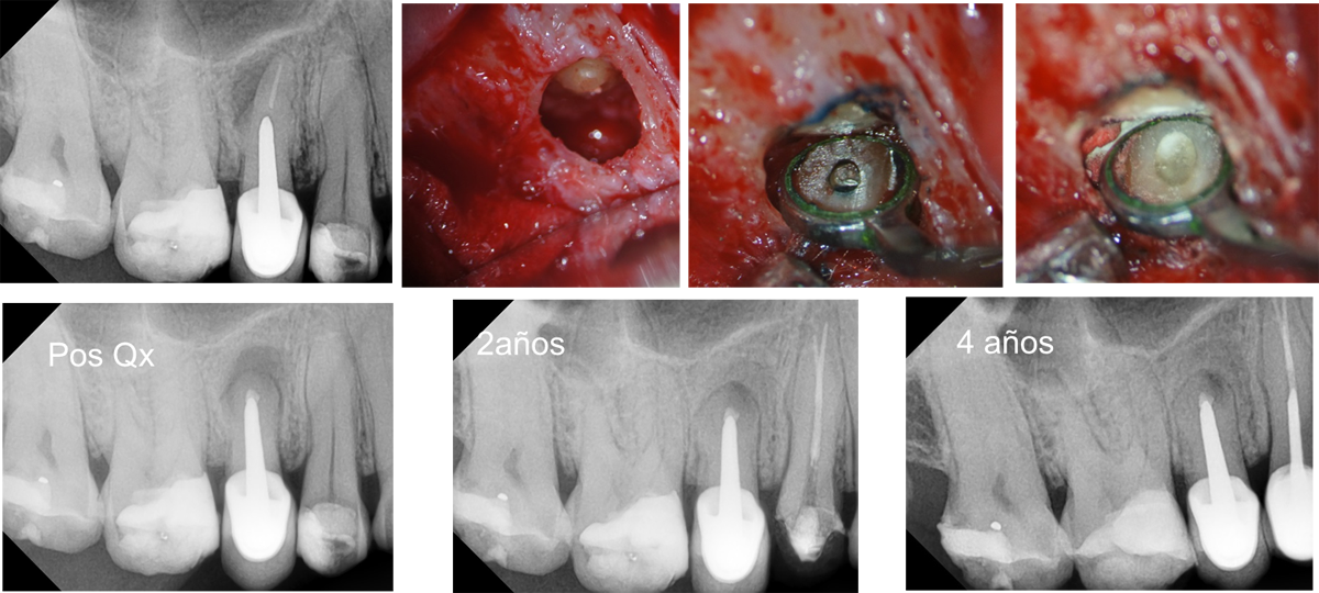 Servicios – Felipe Restrepo Restrepo. Endodoncia Especializada